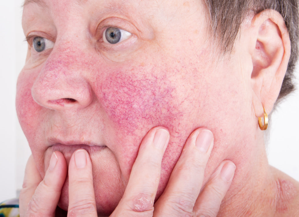 What Causes Rosacea on the Nose? – Balmonds
