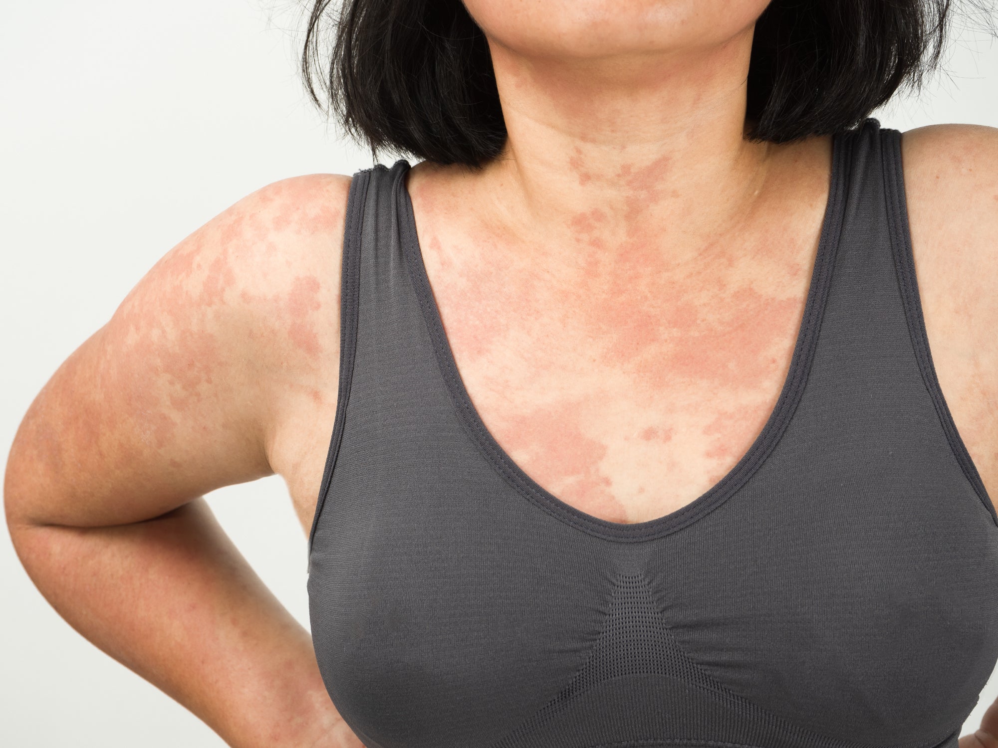 Can Anxiety Cause Rashes? – Balmonds