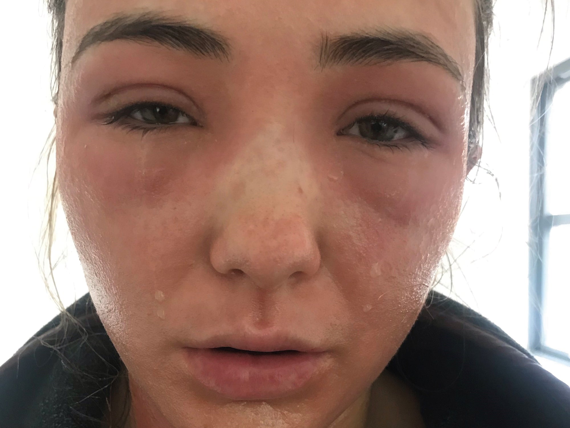 Steroid Abuse Face