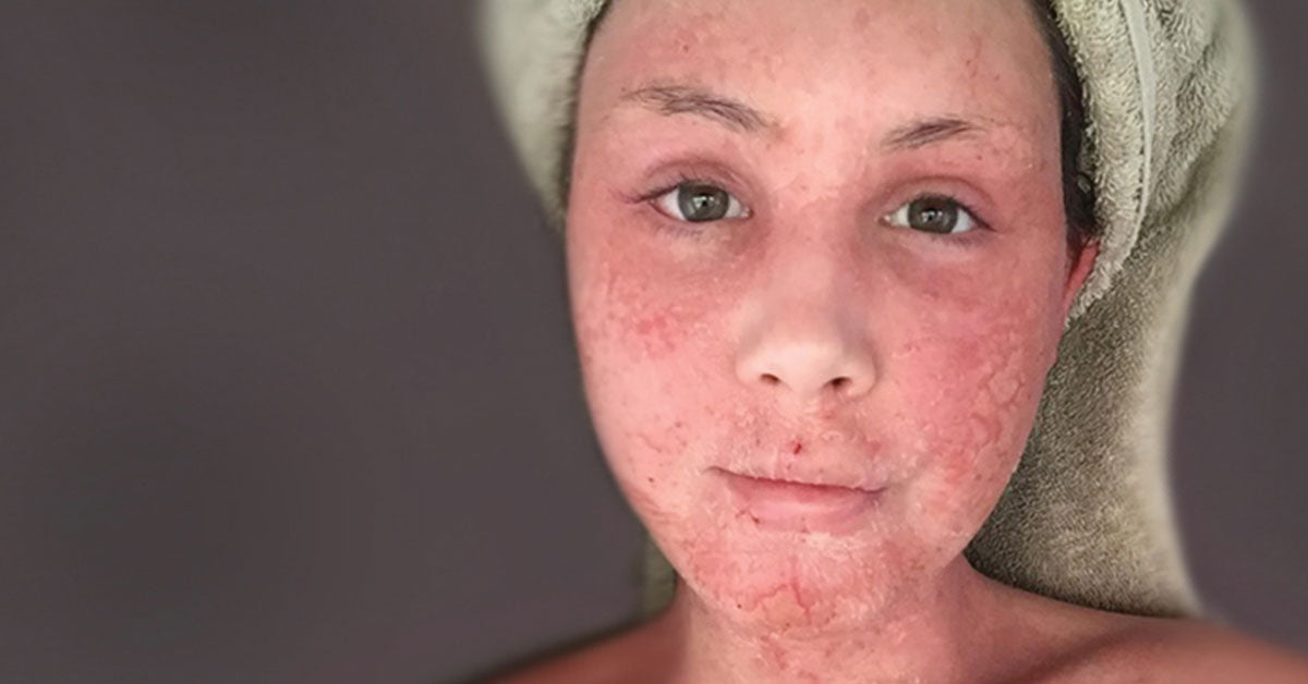 Steroid Abuse Face