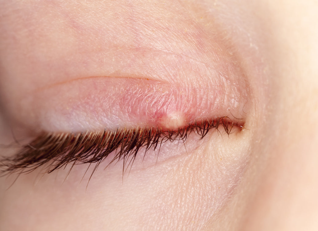How Can You Tell The Difference Between A Stye And Blepharitis? – Balmonds