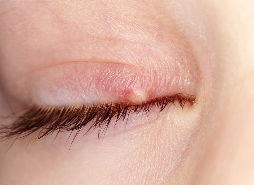 How Can You Tell The Difference Between A Stye And Blepharitis? – Balmonds