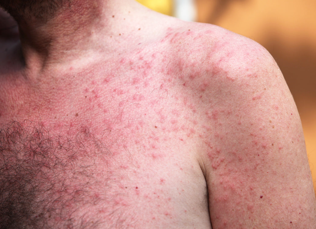 How Common Is Polymorphic Light Eruption? – Balmonds