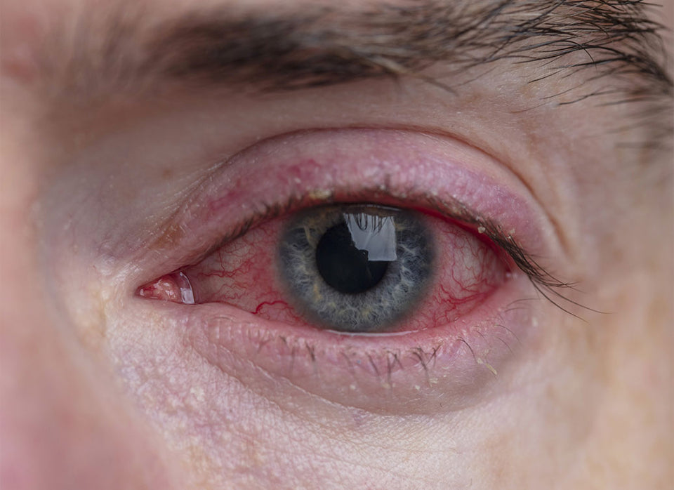 Info Hub – Tagged "Blepharitis" – Balmonds