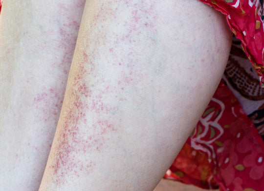 What Does Polymorphic Light Eruption Look Like? – Balmonds