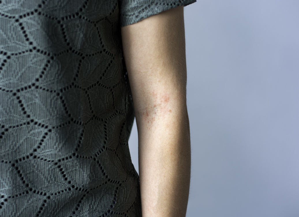 Is Polymorphic Light Eruption An Autoimmune Disease? – Balmonds