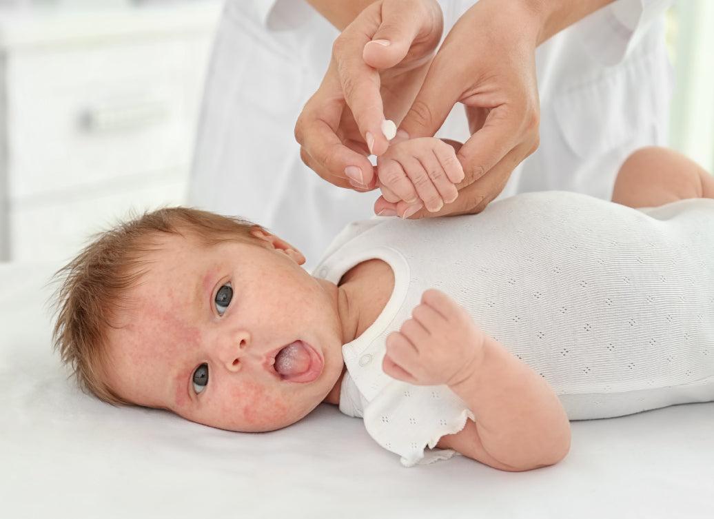 What’s The Best Cream For Baby Eczema? – Balmonds