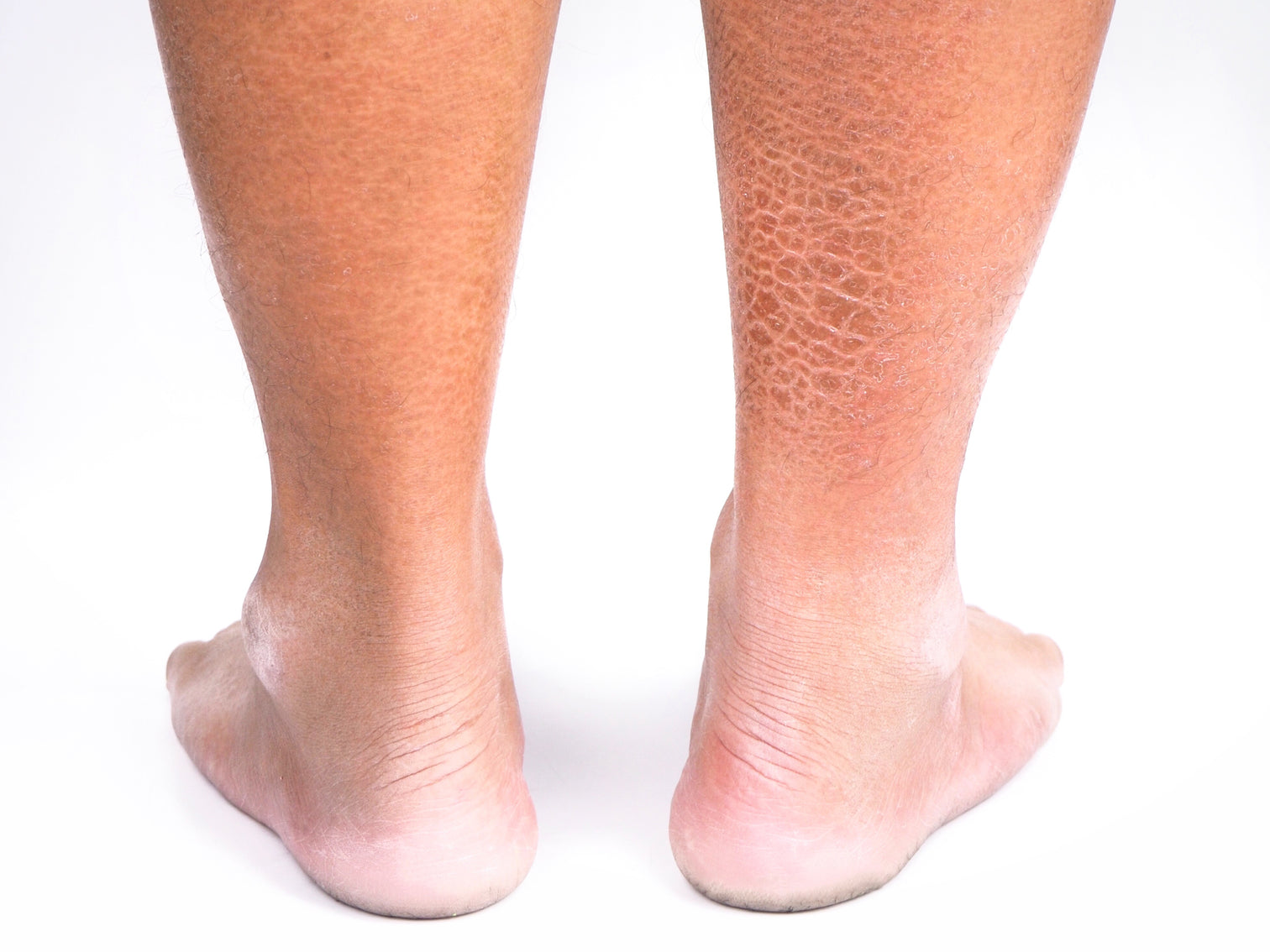 What Part Of The Skin Is Affected By Ichthyosis? – Balmonds