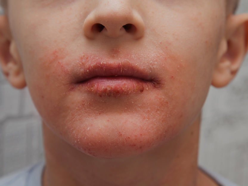 What Causes Perioral Dermatitis? – Balmonds