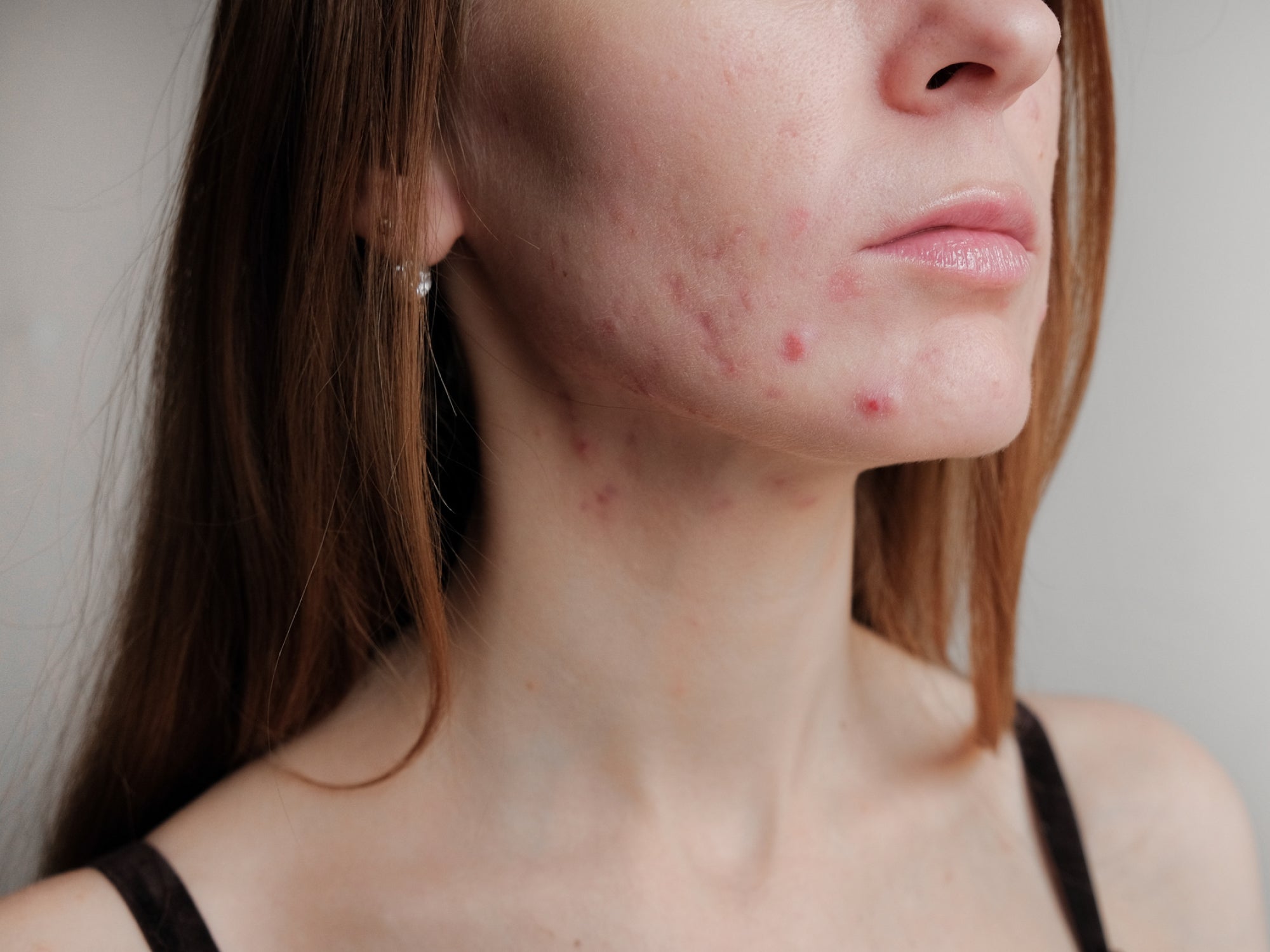 What Worsens Perioral Dermatitis? – Balmonds